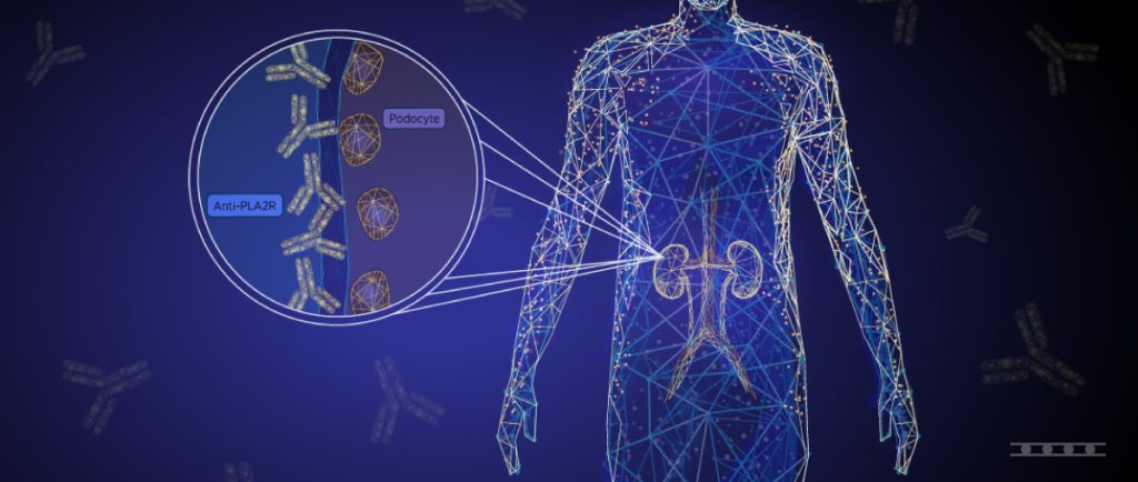 The Role of anti-PLA2R Antibody Testing in Membranous Nephropathy ...